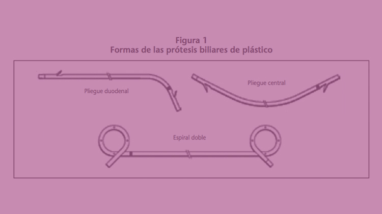 Clasificación y gestión de prótesis biliares - ILAPHAR | Revista de la OFIL